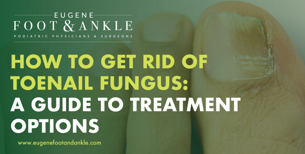 How to Get Rid of Toenail Fungus | Eugene Foot & Ankle