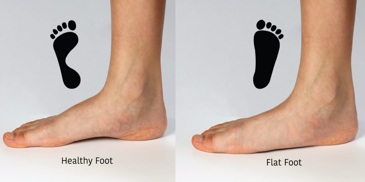 Arch Support 101 | Keeping Feet Healthy | Eugene Foot & Ankle