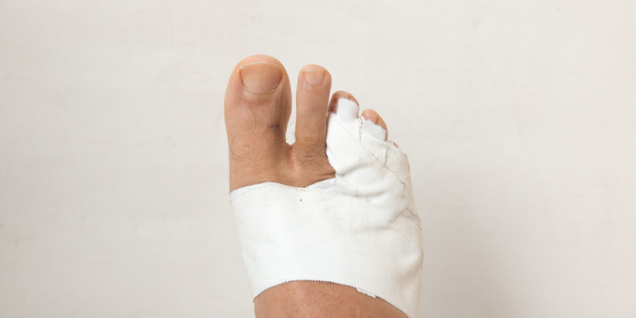Broken Toe? | What to Know | Eugene Foot & Ankle