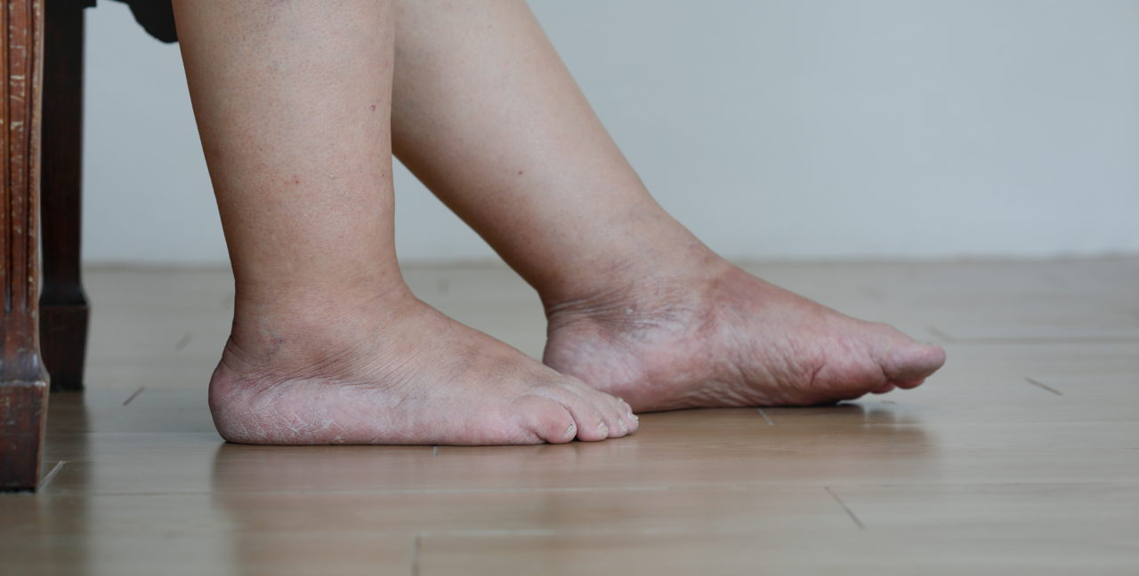 Poor Circulation in Feet? What to Know | Eugene Foot & Ankle