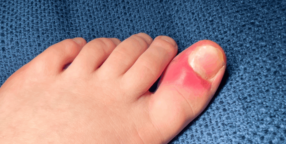 Stubbed, Sprained, or Broken? Finding the Cause of your Toe Pain